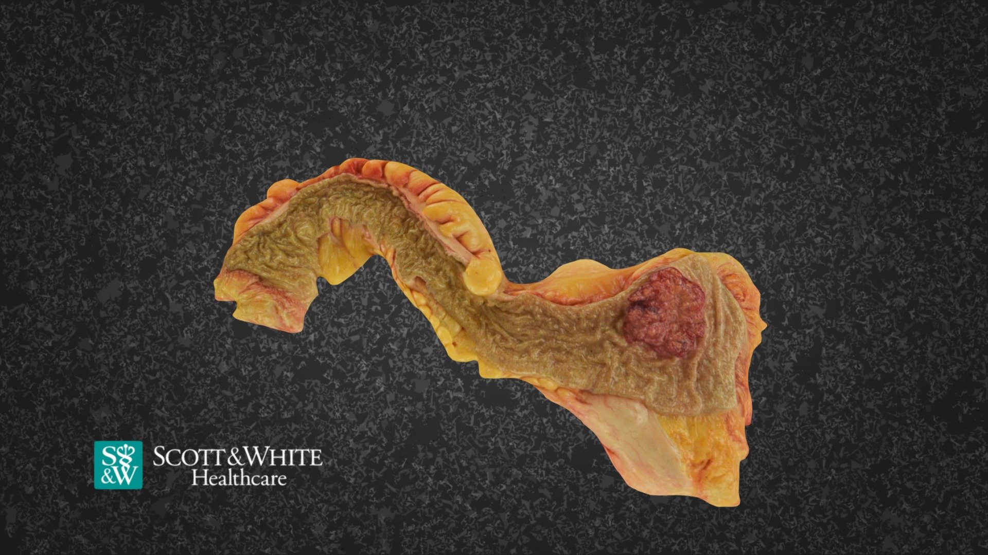 Rectosigmoid 108911 - 3D model by Scott & White Moulage Project ...