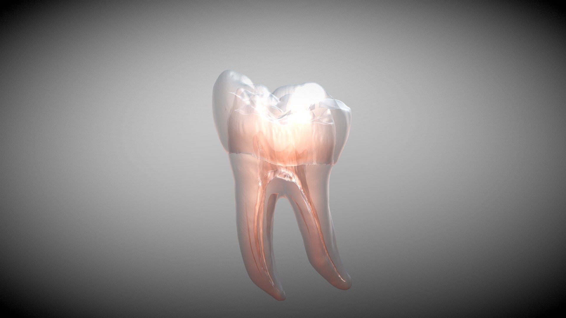 Mandibular 1st molar (pulp segmented) - 3D model by MedHive3D ...