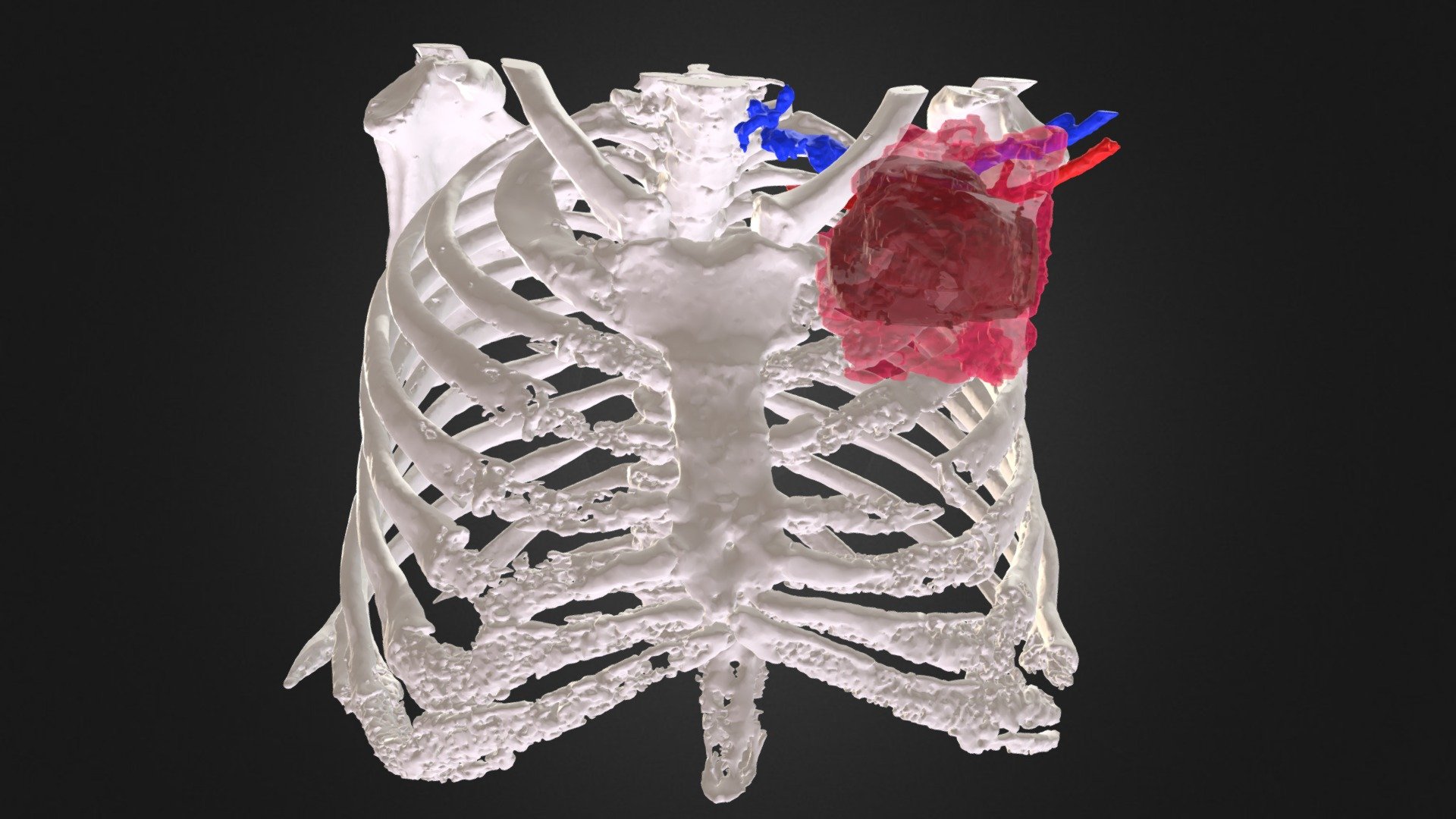 Left Pectoral Sarcoma - 3D model by yuhuihuang [4fb383d] - Sketchfab