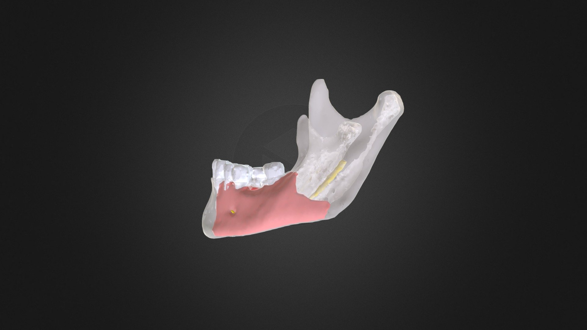 Mandibular Squamous Cell Carcinoma - 3D model by yuhuihuang [50aca9d ...