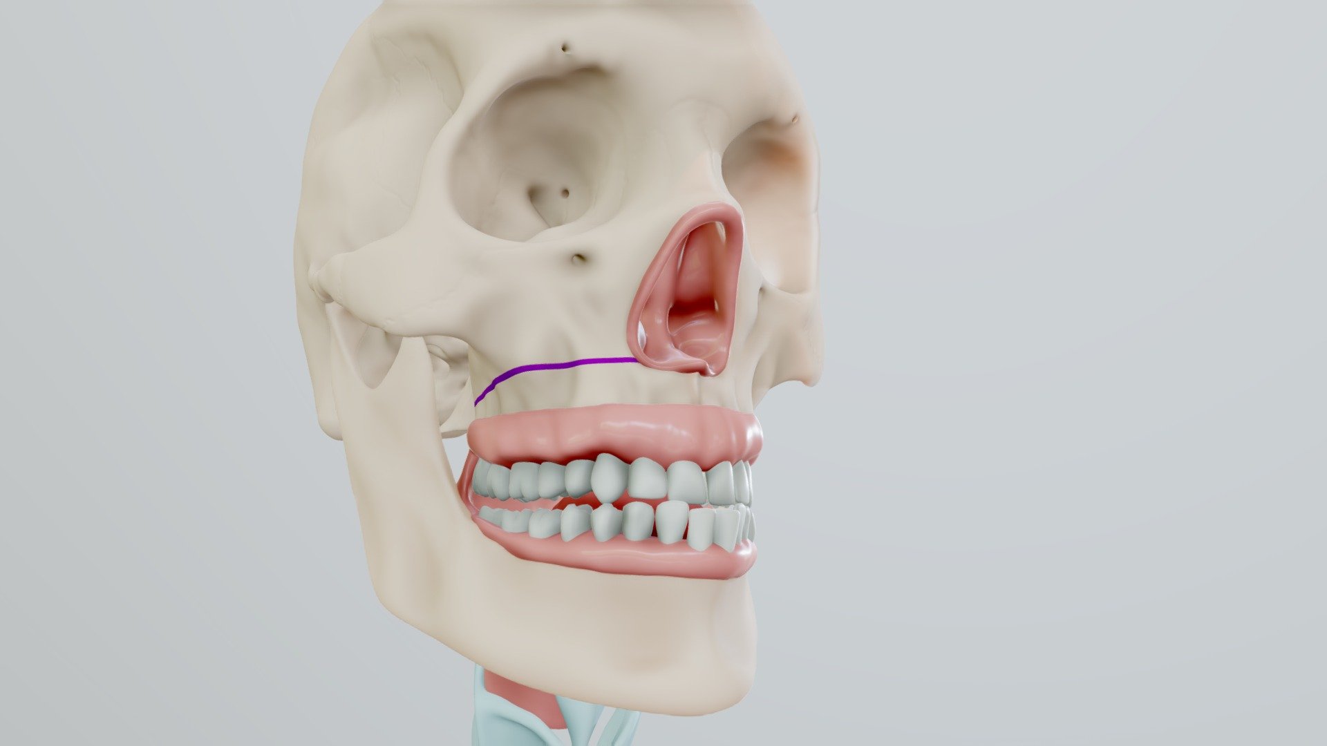 Le Fort 1 Step 1: Lateral Osteotomy - 3D model by AUmedart [50f1a39 ...
