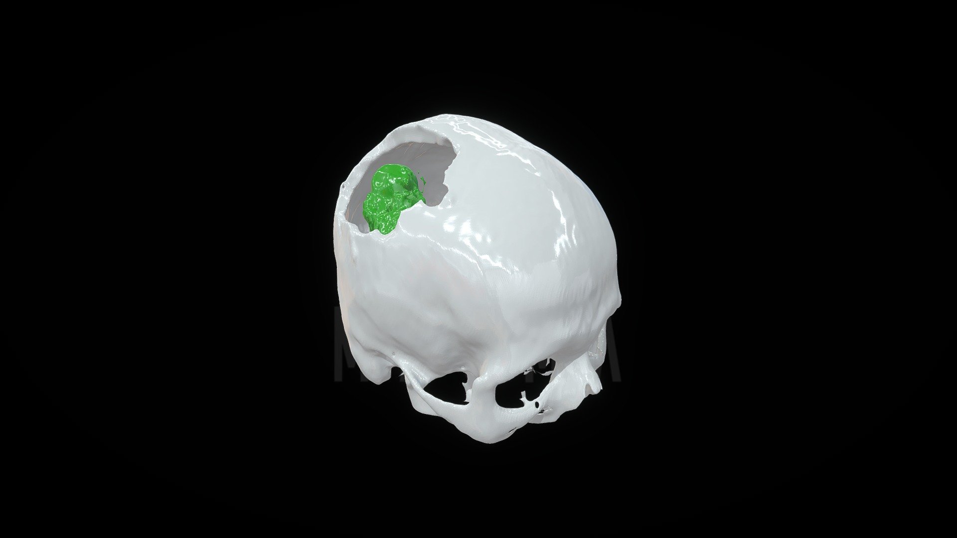 Recurrent Glioblastoma - Buy Royalty Free 3D model by Dr. Samuel Damin ...