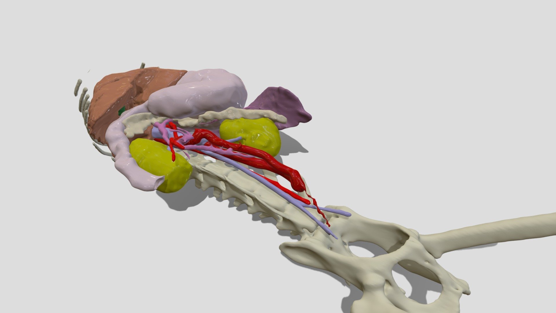 Shunt Planejamento Cirúrgico - 3D model by Impetux [51aab6b] - Sketchfab