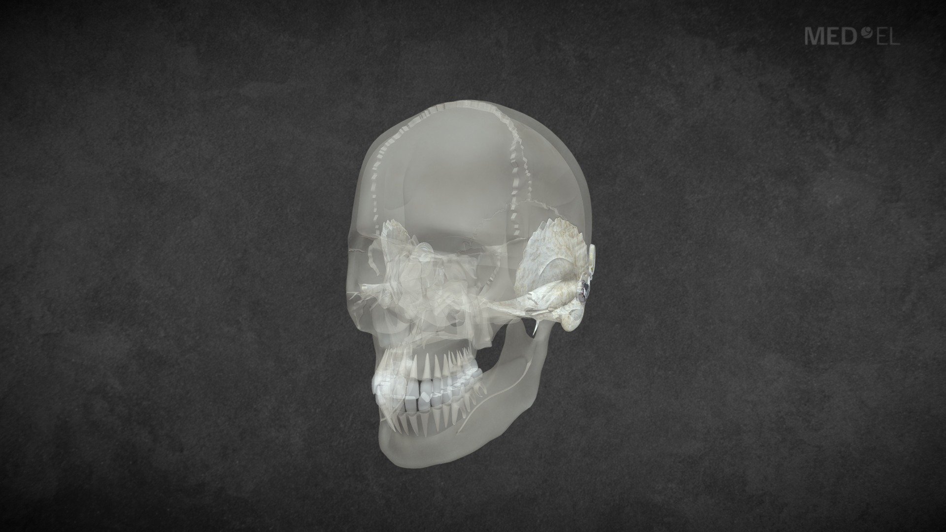 Bilateral BONEBRIDGE in Temporal Bones - 3D model by **m3del-USA ...