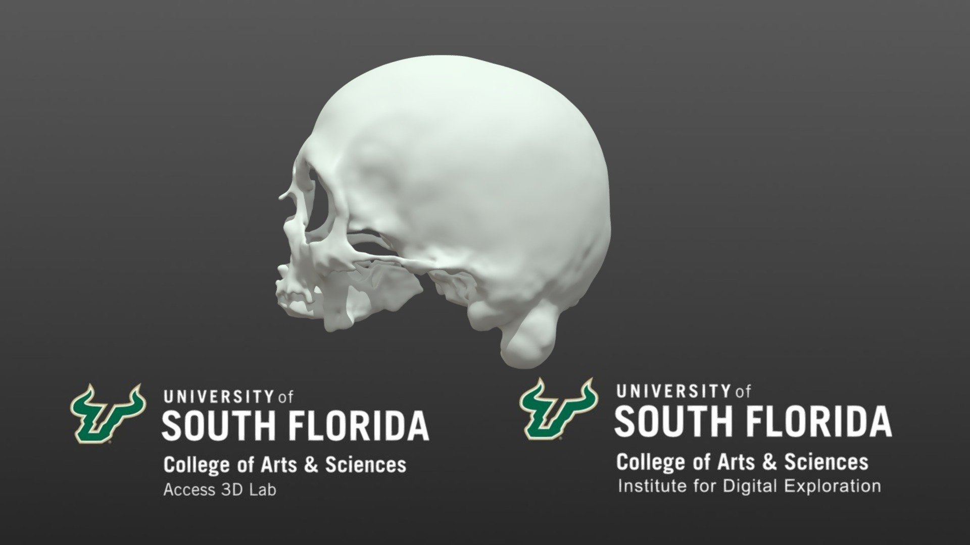 Skull with an Occipital Osteoid Osteoma - 3D model by access3d [5352abd ... Skull with an Occipital Osteoid Osteoma - 3D model by access3d [5352abd ...