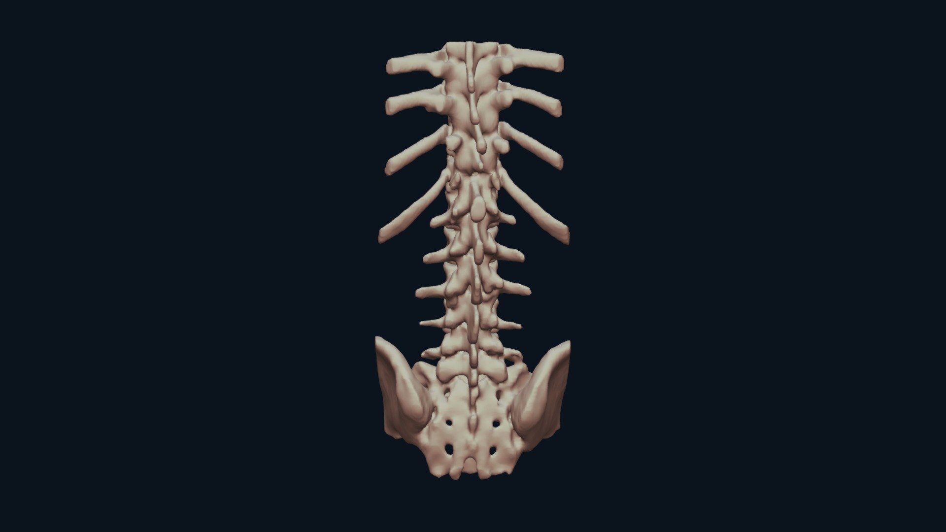 Spine with pars defect - 3D model by Jack (@perkins) [53e66ff] - Sketchfab
