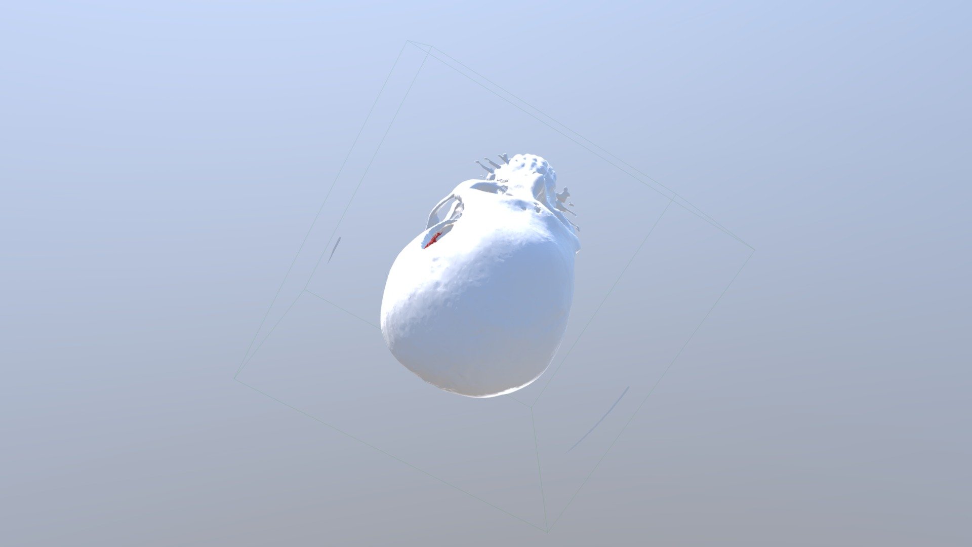 Left pterional approach - MCA aneurysm - 3D model by Nicolás González R ...