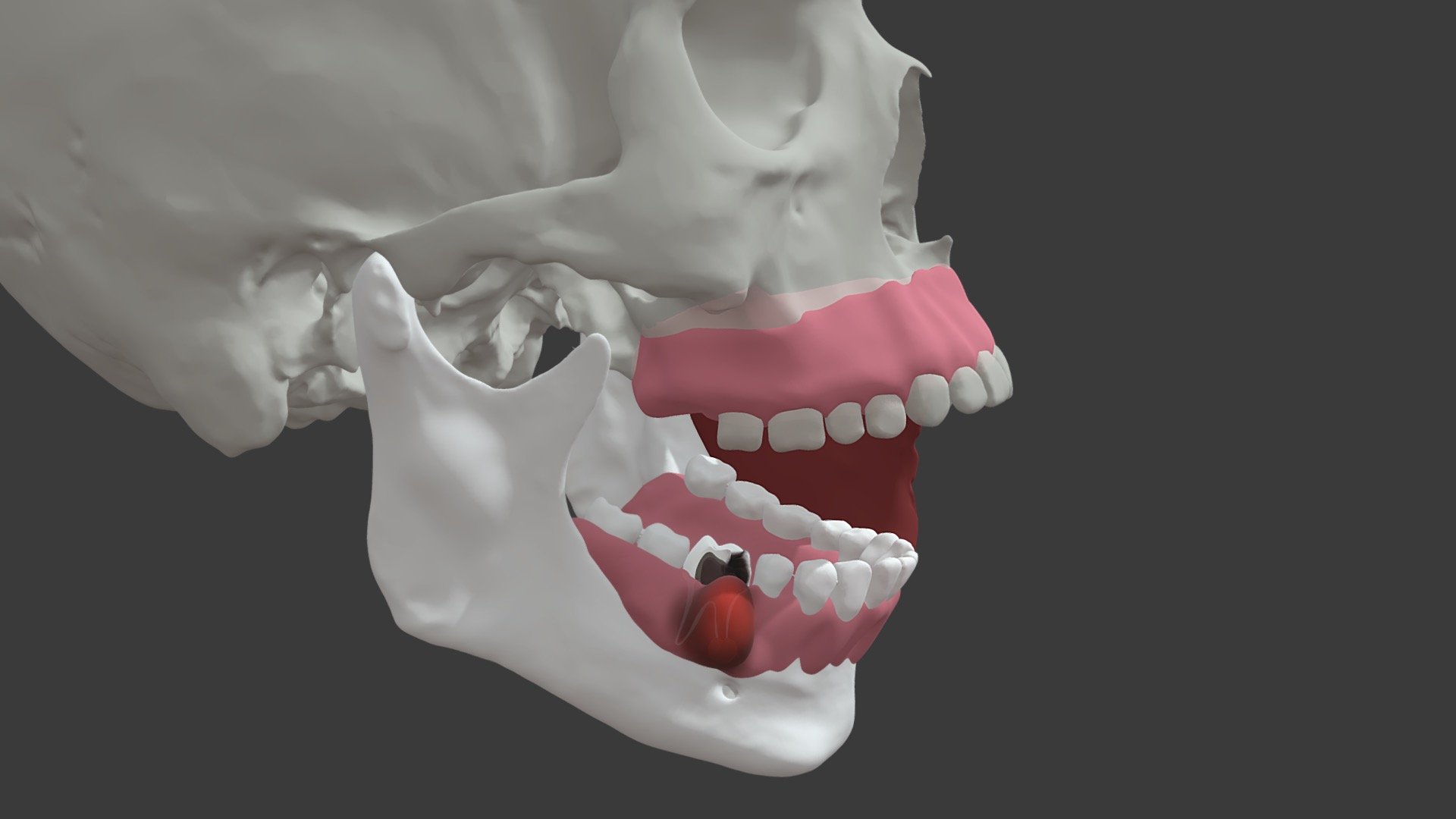 Stage 5 Mandibular molar infection Pathway-1 - 3D model by University ...