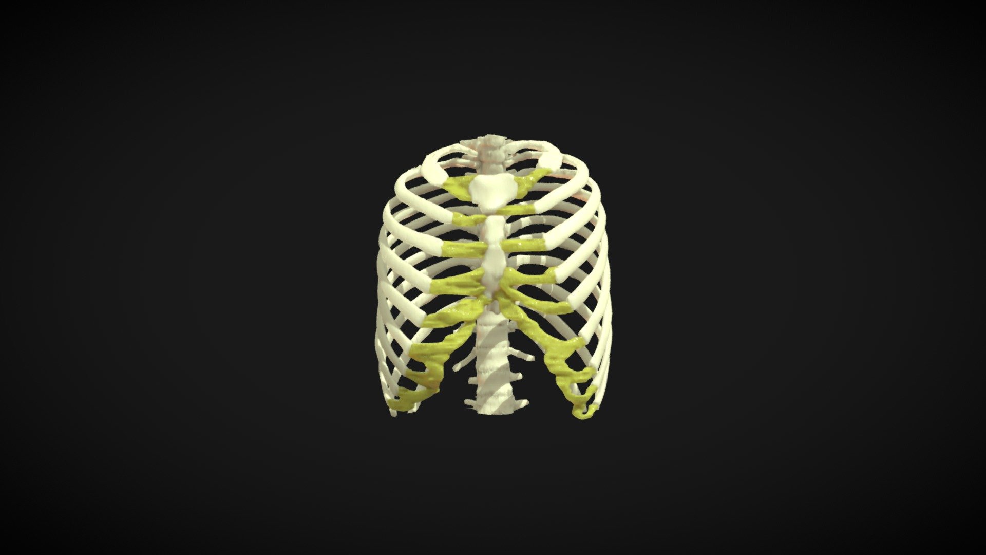 Pectus excavatum case - 3D model by Lincoln Wong (@lincolnwong ...