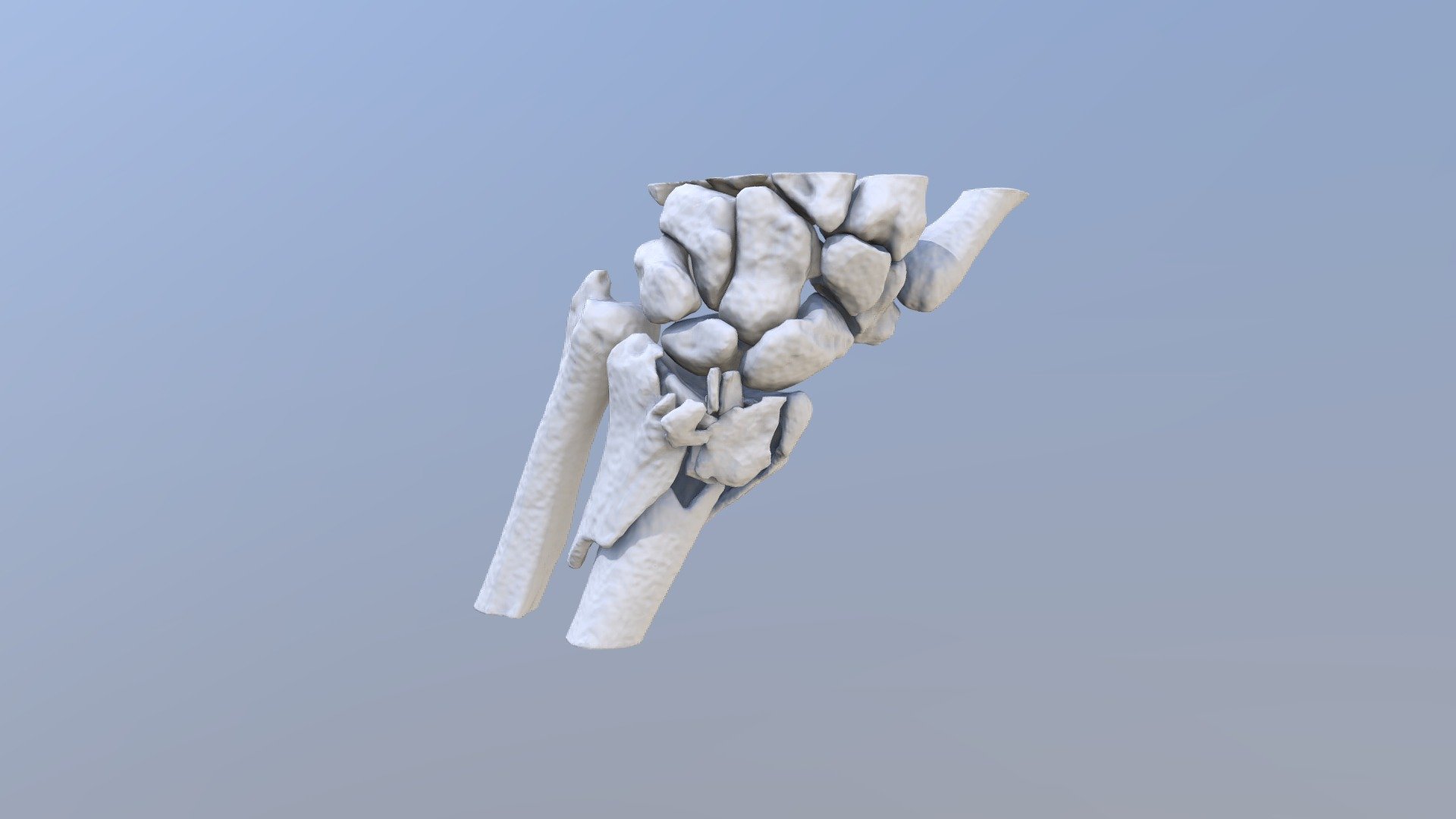 Comminuted fracture of the distal radius - 3D model by Innowise: VOKA ...