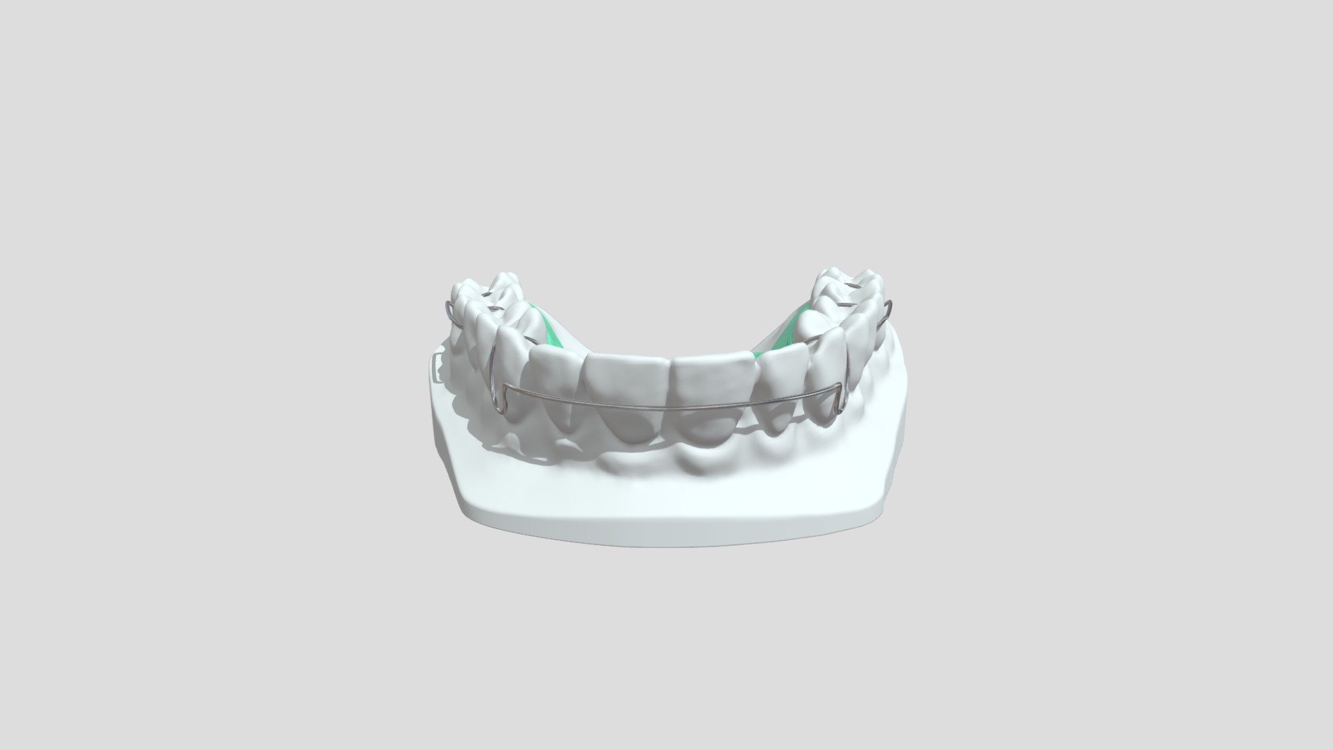 Spring Aligner - 3D model by ODL OrthoLab (@Odlortho) [54b9318] - Sketchfab