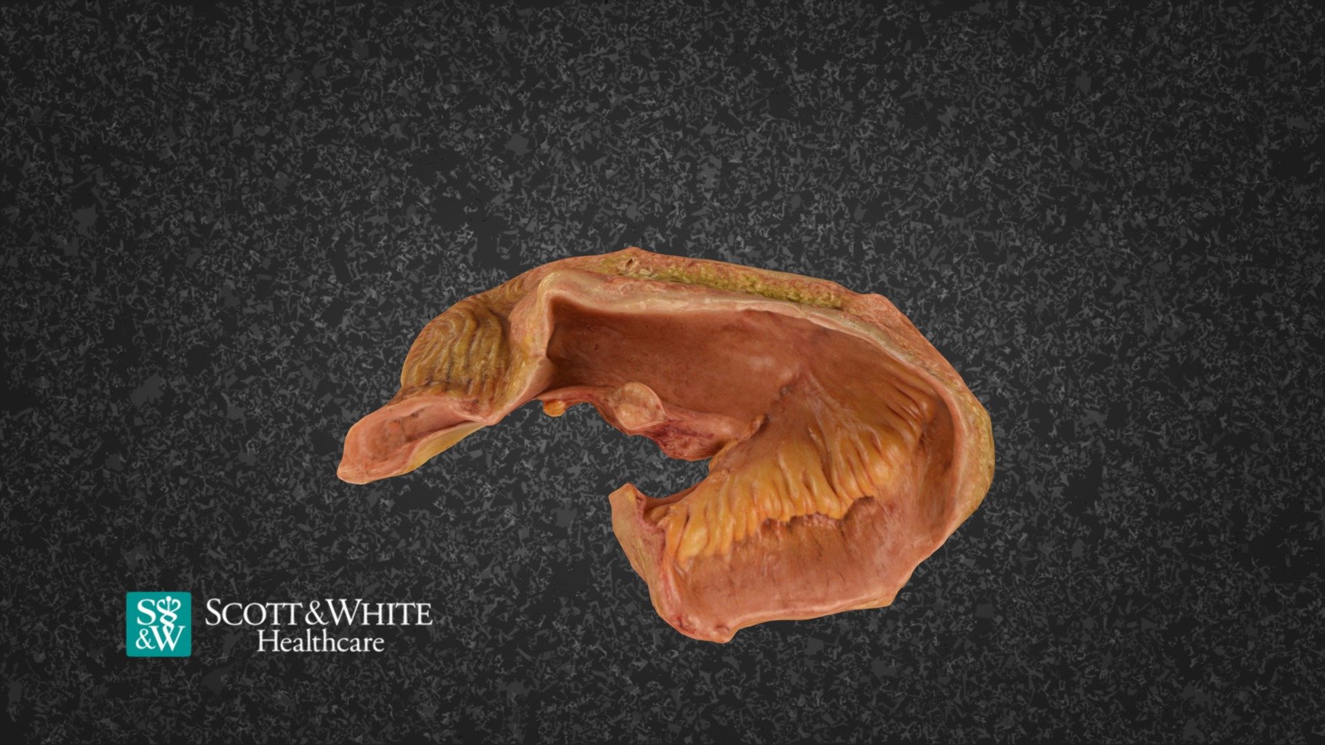 Ileum Lymphosarcoma 104305 - 3D model by Scott & White Moulage Project ...
