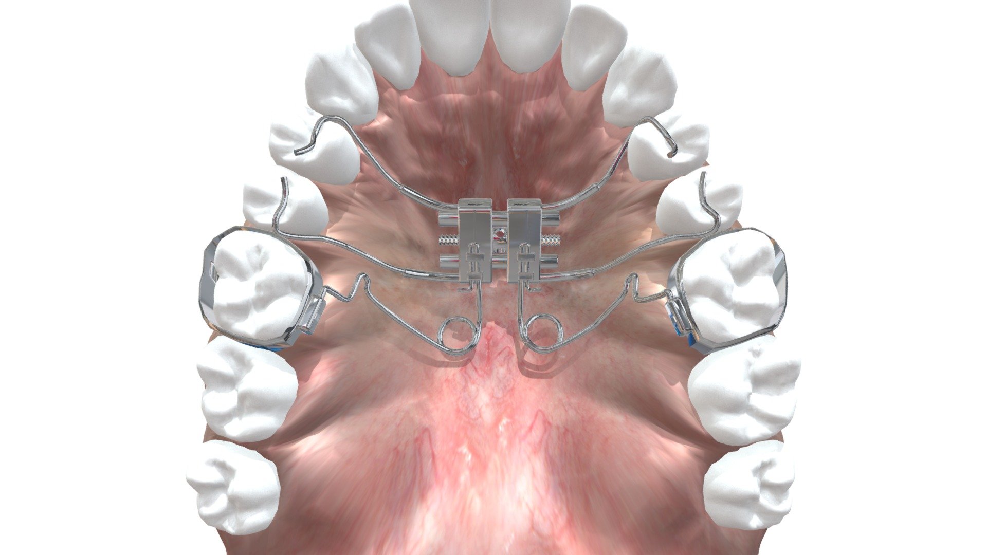 4. HILGERS DISTALIZER - 3D model by Interactive 3D Data ...