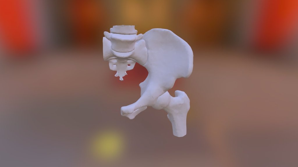 Acetabular Fracture - sku 244 - 3D model by orto3d [55d44af] - Sketchfab