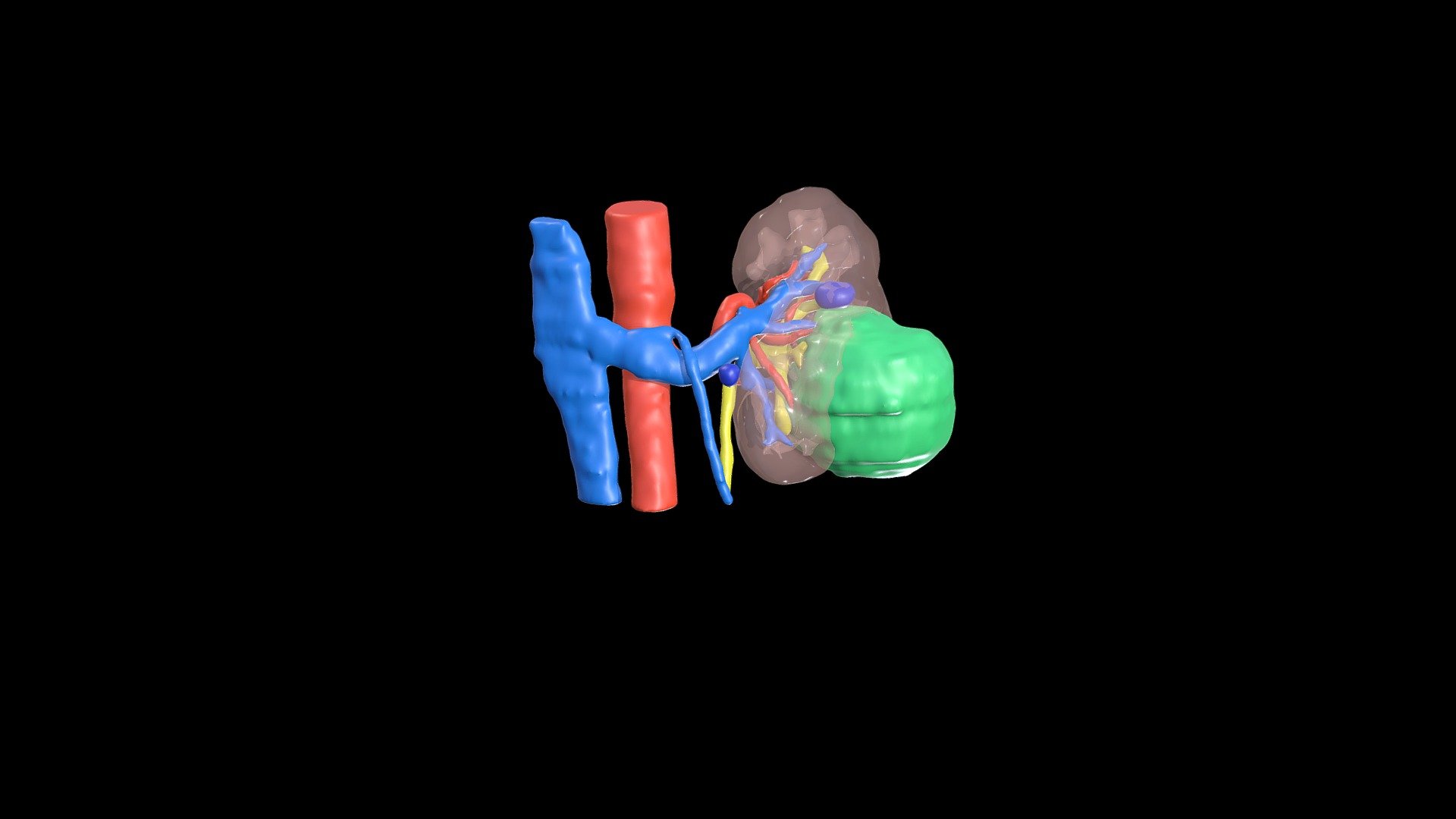 Left Renal Tumor - 3D model by Cirurgic3D (@neorenal) [55ee3df] - Sketchfab