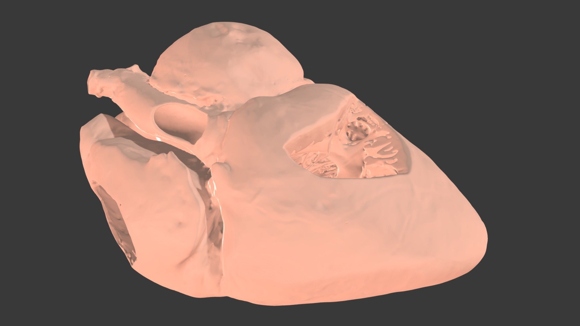 Dorv 3 Dorv {s D D} With Subpulmonary Vsd 3d Model By Heartmodels
