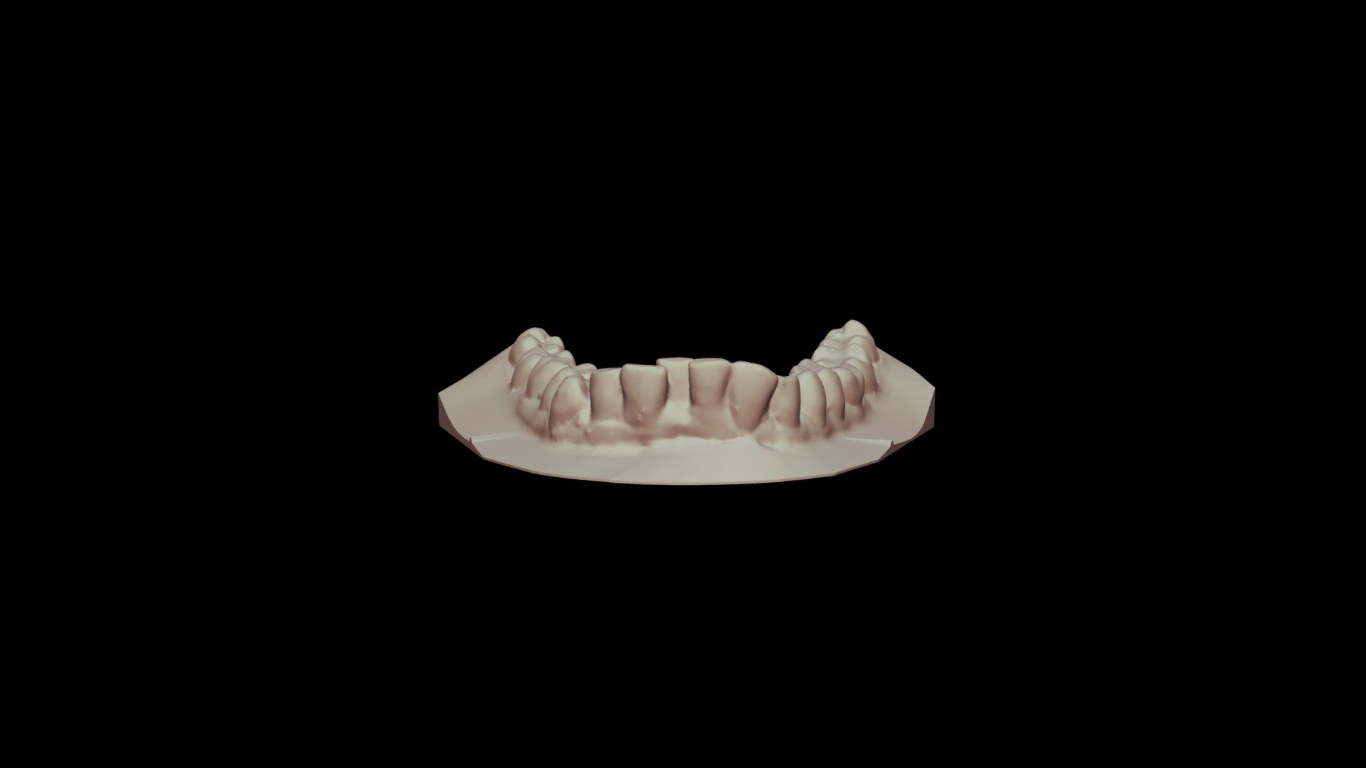 Patient 1: Mandibular Cast - 3D model by bchui [56db66b] - Sketchfab