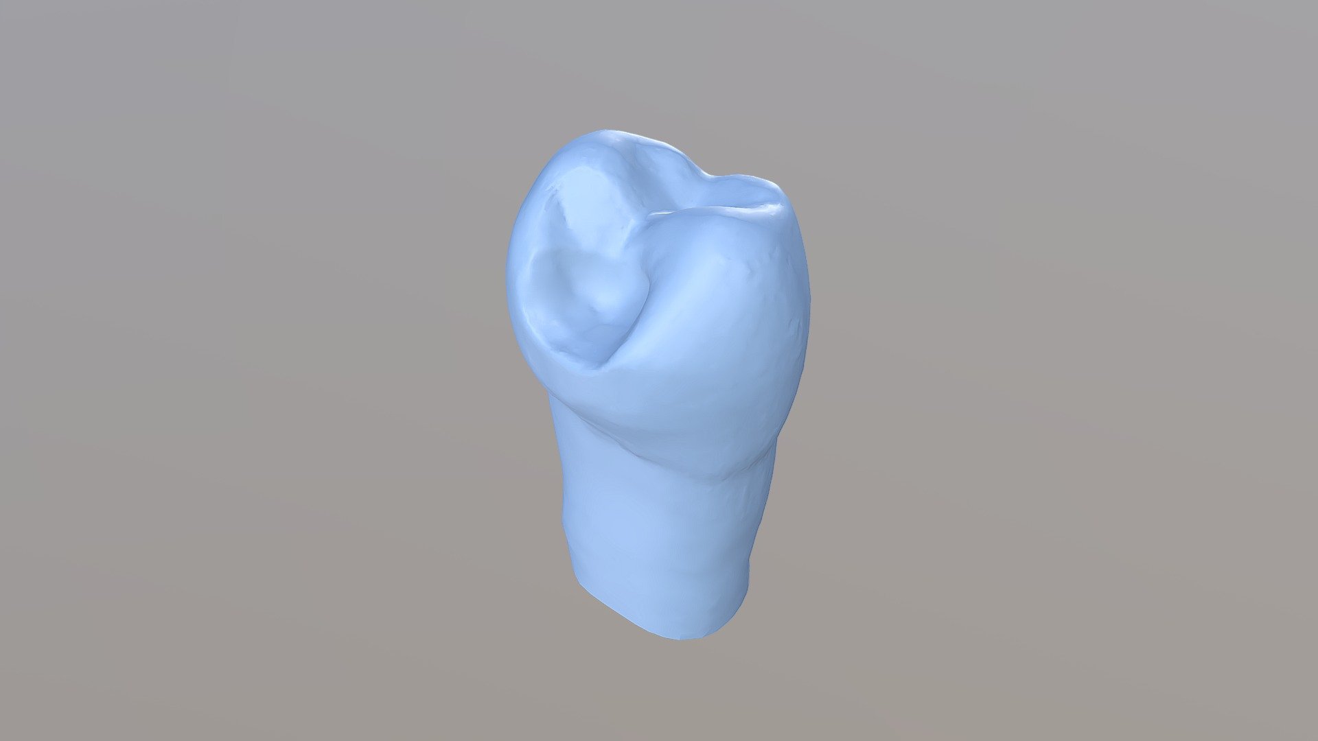 Rest Seat 29 Distal Occlusal with Guide Plane - 3D model by ramiammoun ...