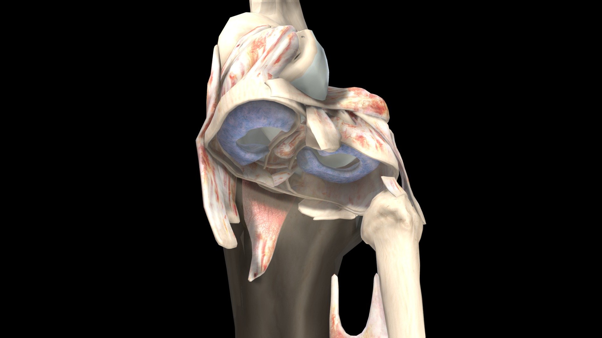 Patellar Tendonitis - 3D model by IU Indianapolis University Library ...