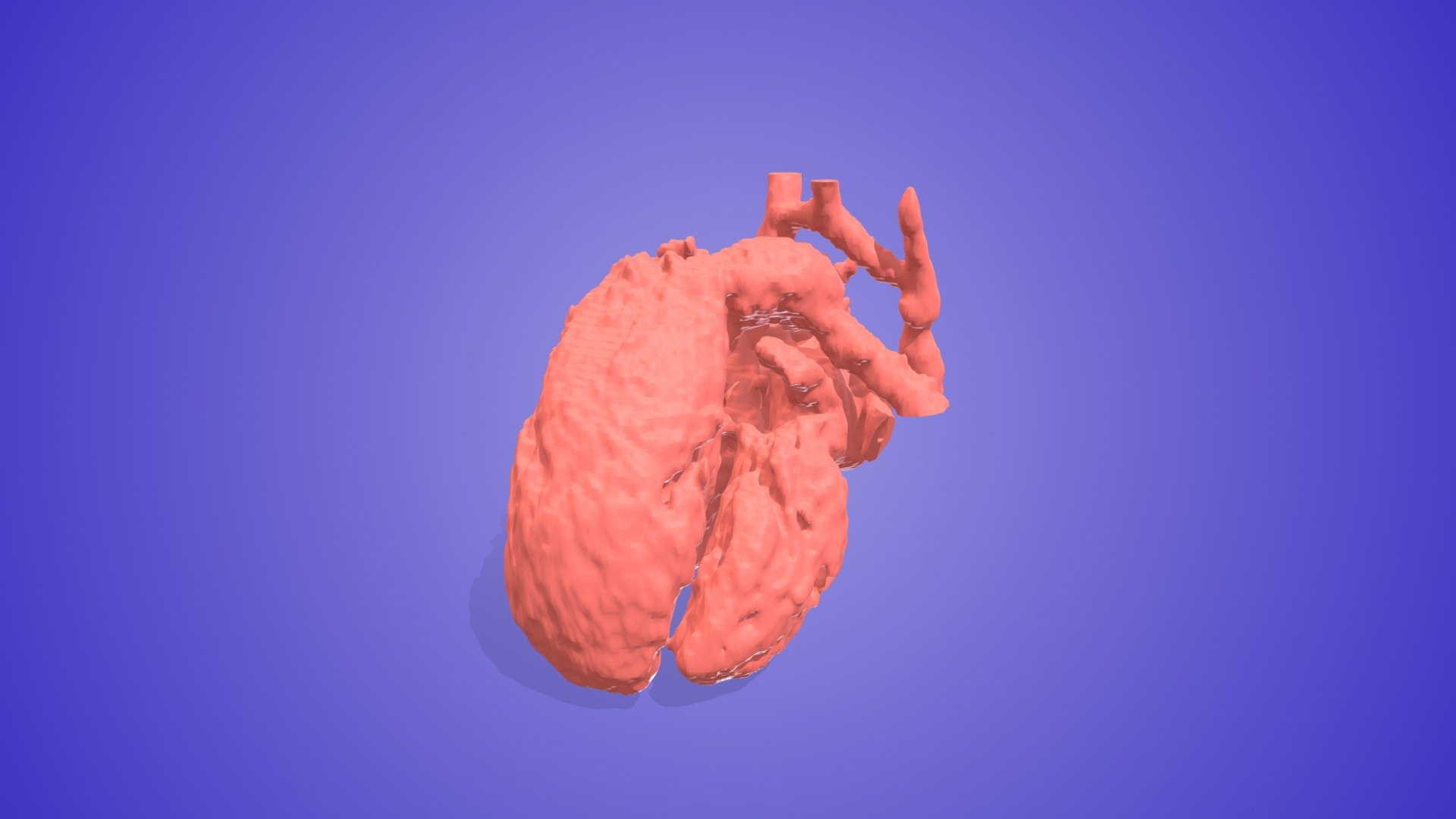 Borderline Left Sided Structures - Download Free 3D model by 3D Heart ...