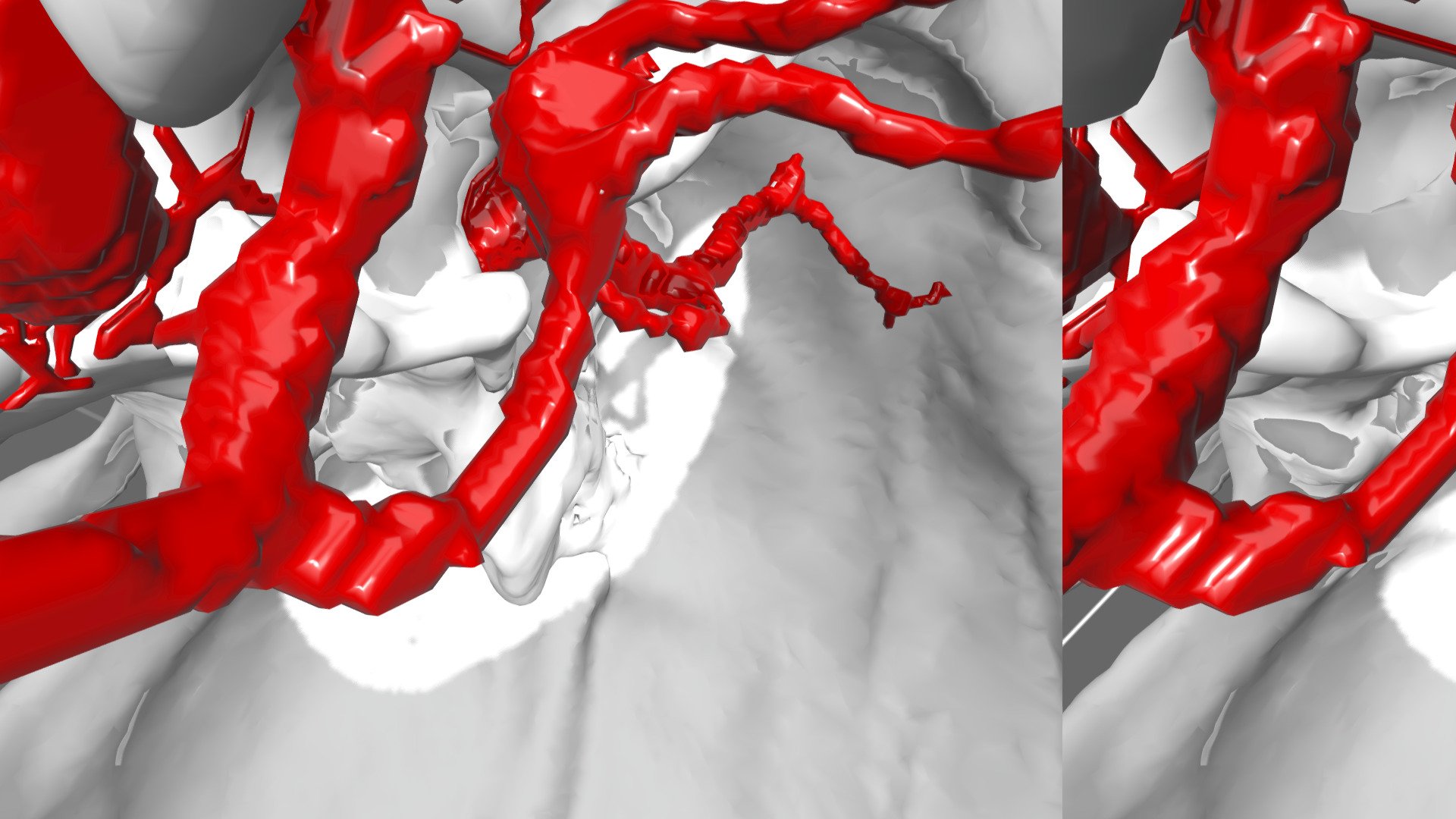 Left pterional approach - AcoA aneurysm - Download Free 3D model by ...