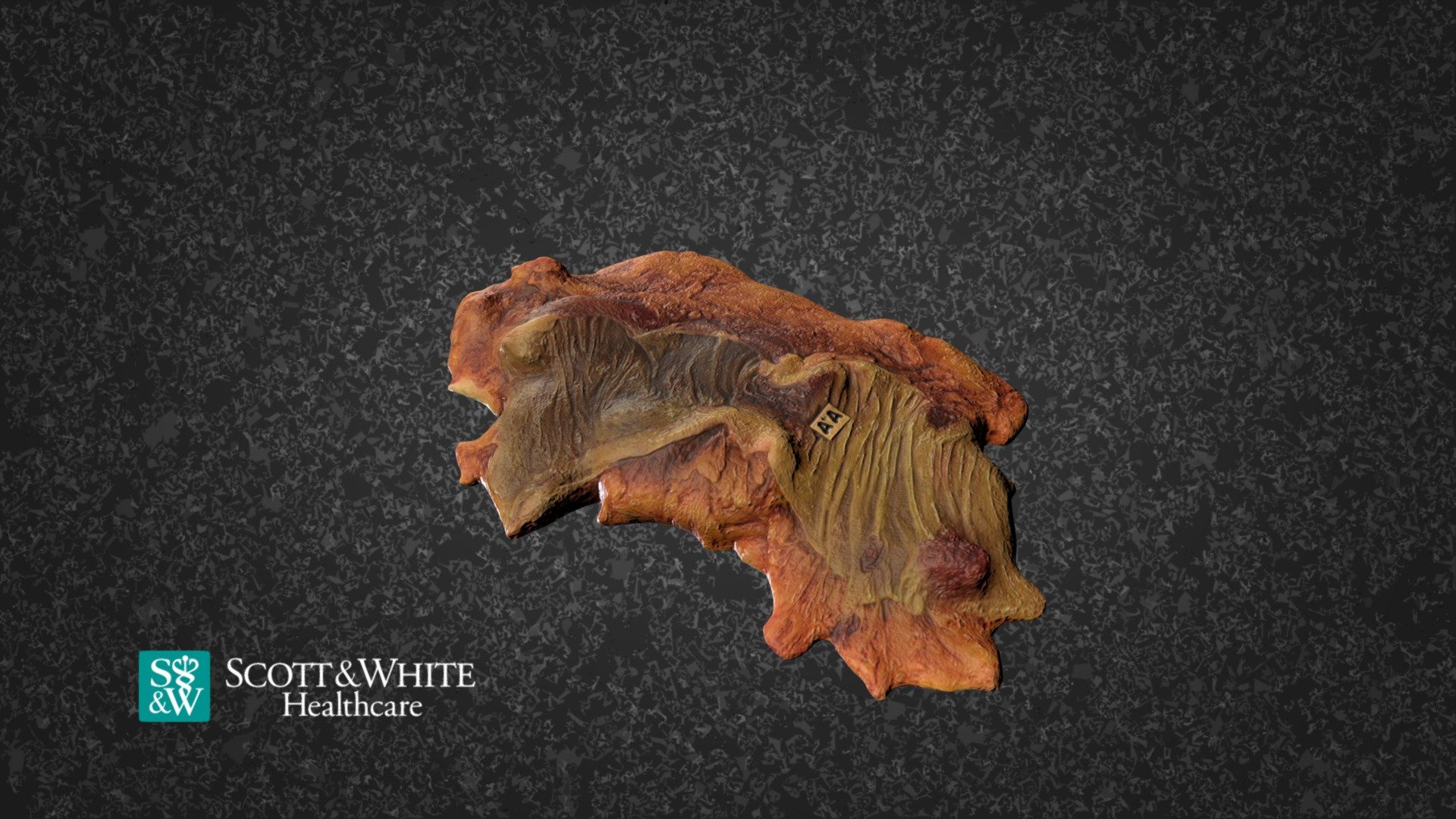 Colon Annular Scirrhous Carcinoma 173536 - 3D model by Scott & White ...