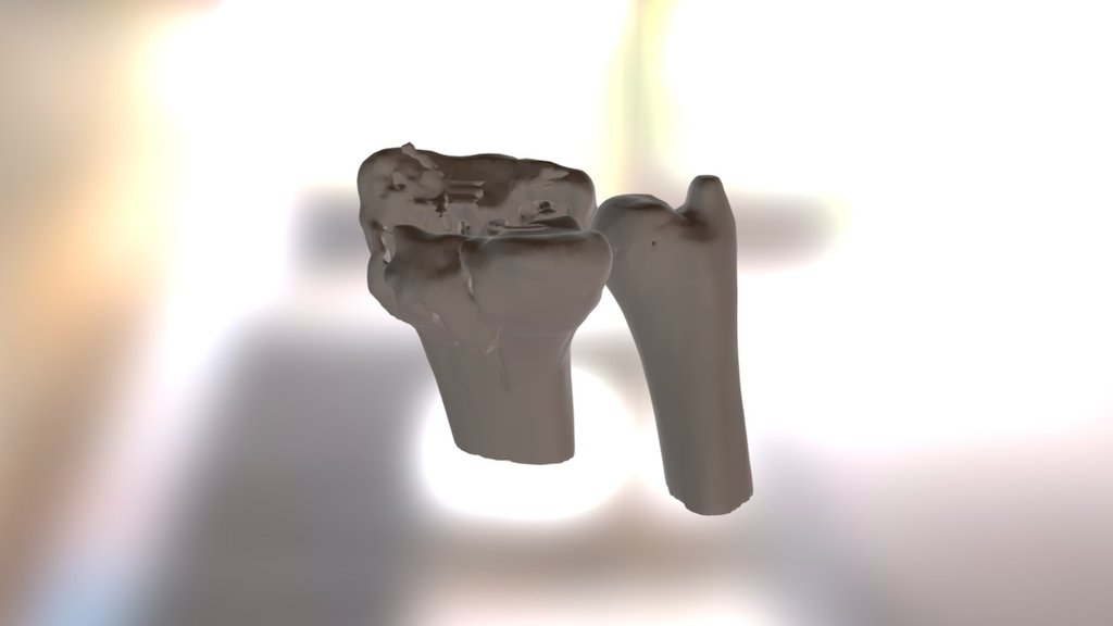 Hand - Distal Radius - 3D model by orto3d [5895669] - Sketchfab