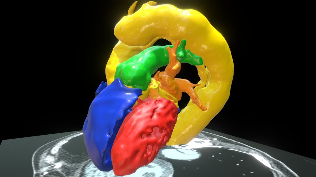 2017000 Normal Heart. Aortic Dissection - Download Free 3D model by ...