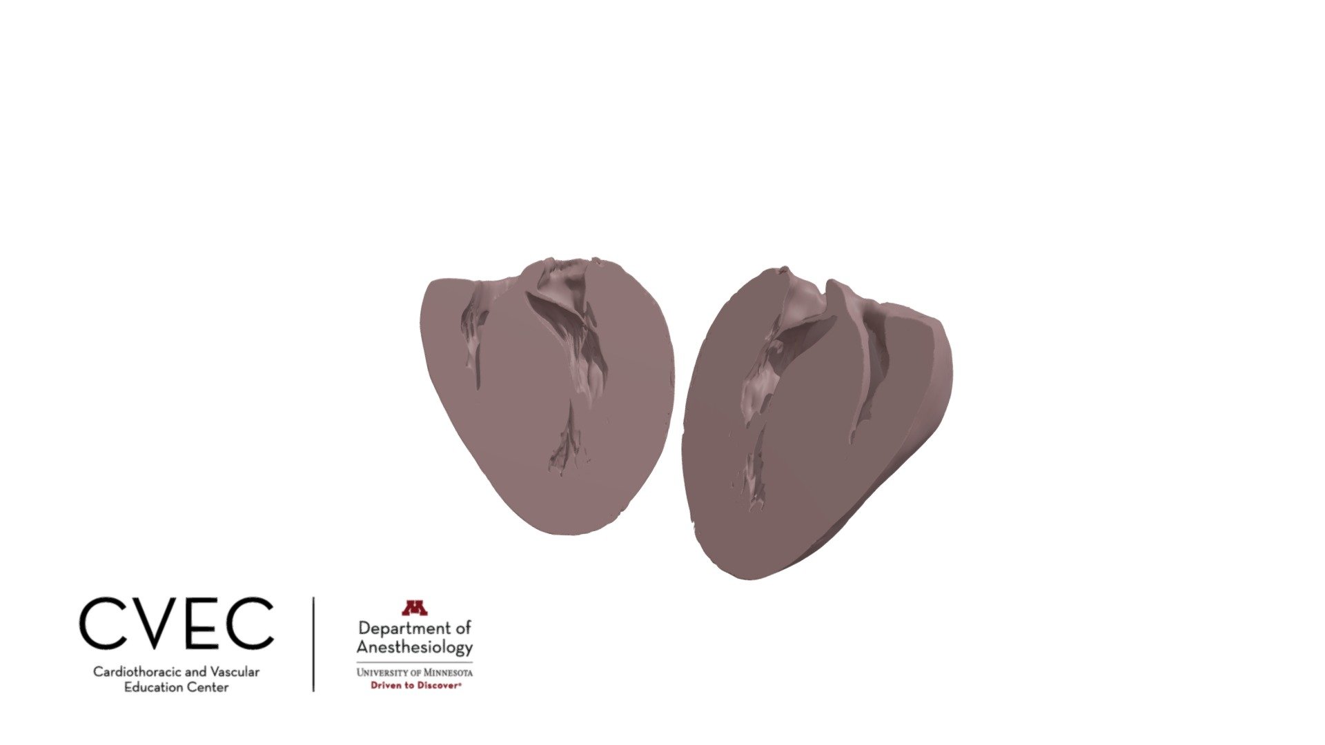 Hypertrophic-cardiomyopathy four-chamber-view - 3D model by CVEC ...