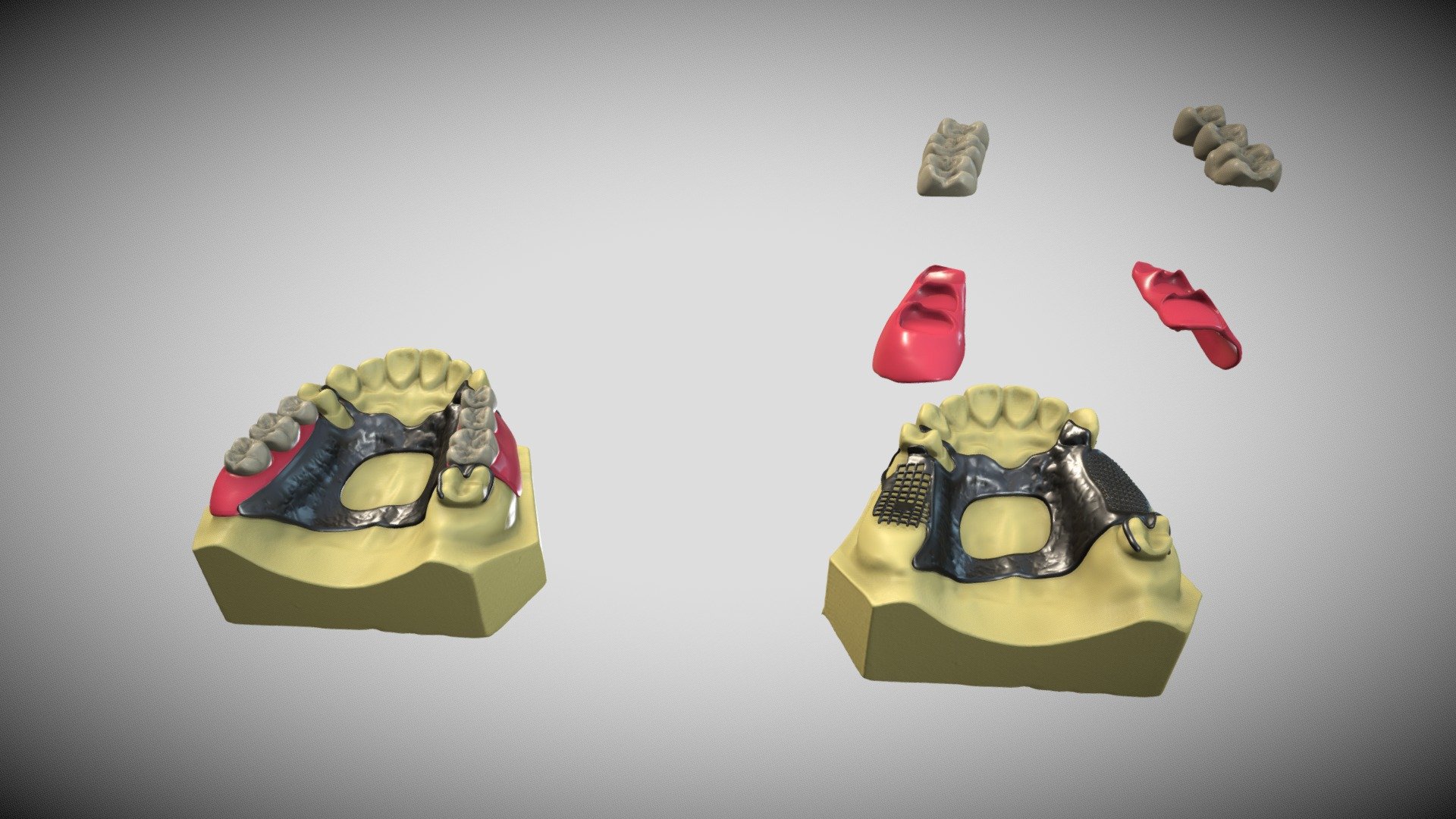Kennedy Class Ii Mod 1 Design Maxillary 3d Model By Muhammad Nabeel