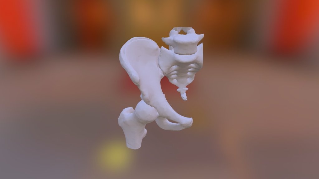 Acetabular Fracture - sku 240 - 3D model by orto3d [59745cd] - Sketchfab