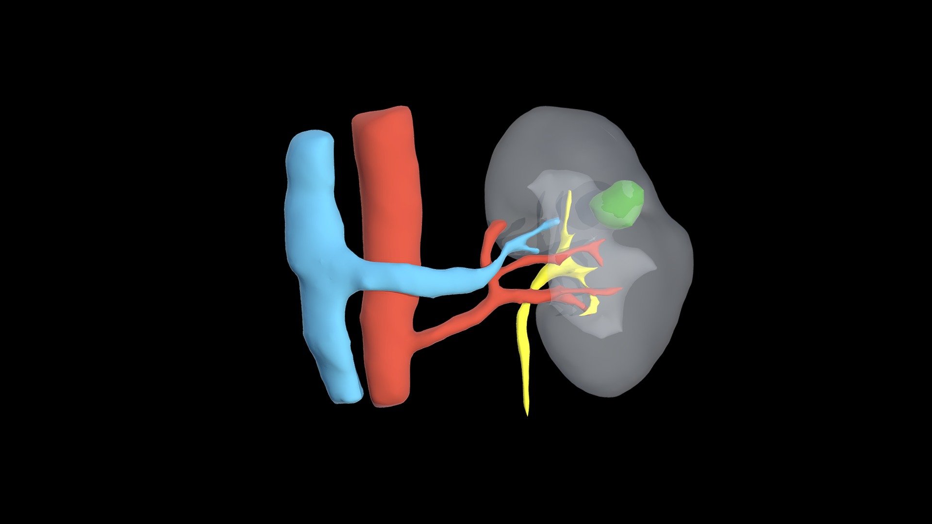 Left Renal Tumor - 3D model by Cirurgic3D (@neorenal) [5a6127f] - Sketchfab