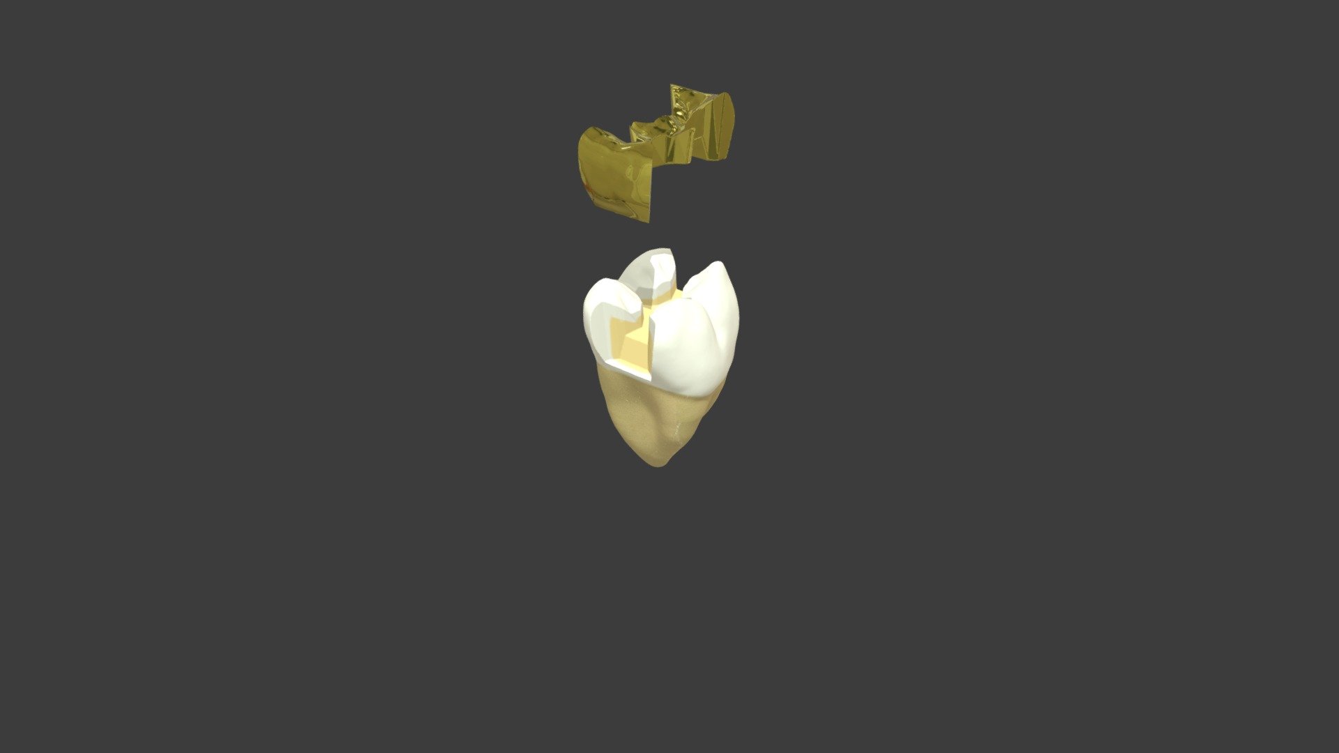 Gold Inlay - 3D model by Ahmed Mahrous (@drahedmahrous) [5b8dcac ...