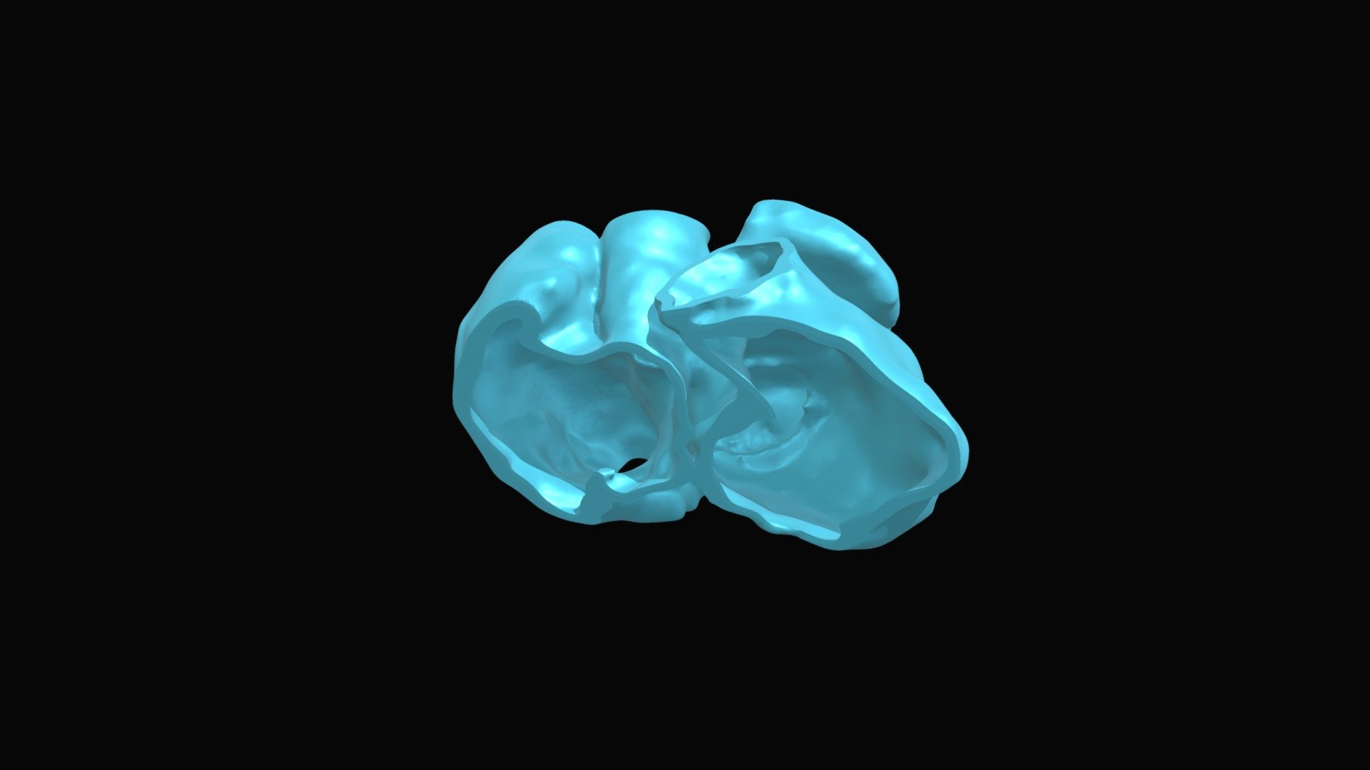 cc-TGA, VSD, Coronal Cut - 3D model by kmaghrabi [5c4ccd5] - Sketchfab