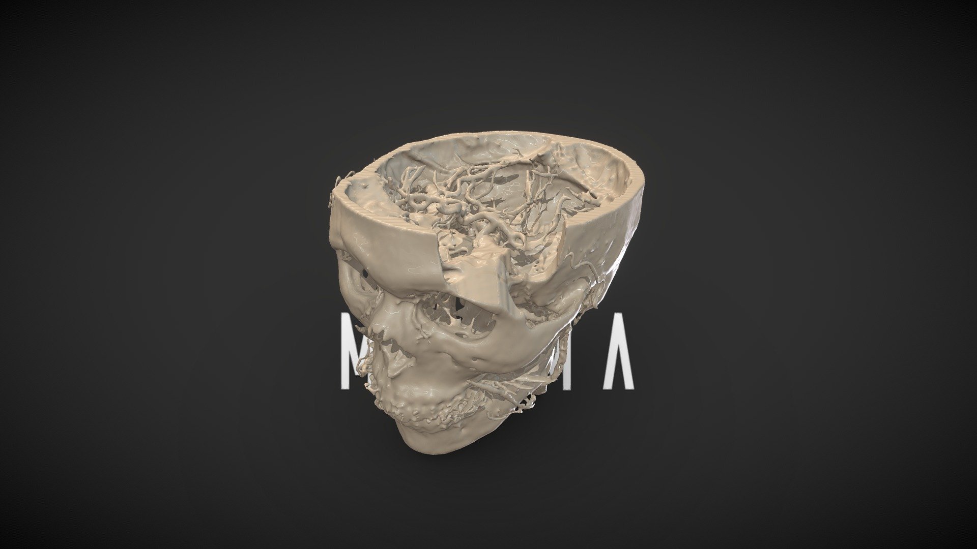 DRGS - Left ICA Aneurysm - 3D model by Dr. Samuel Damin (@sdamin ...