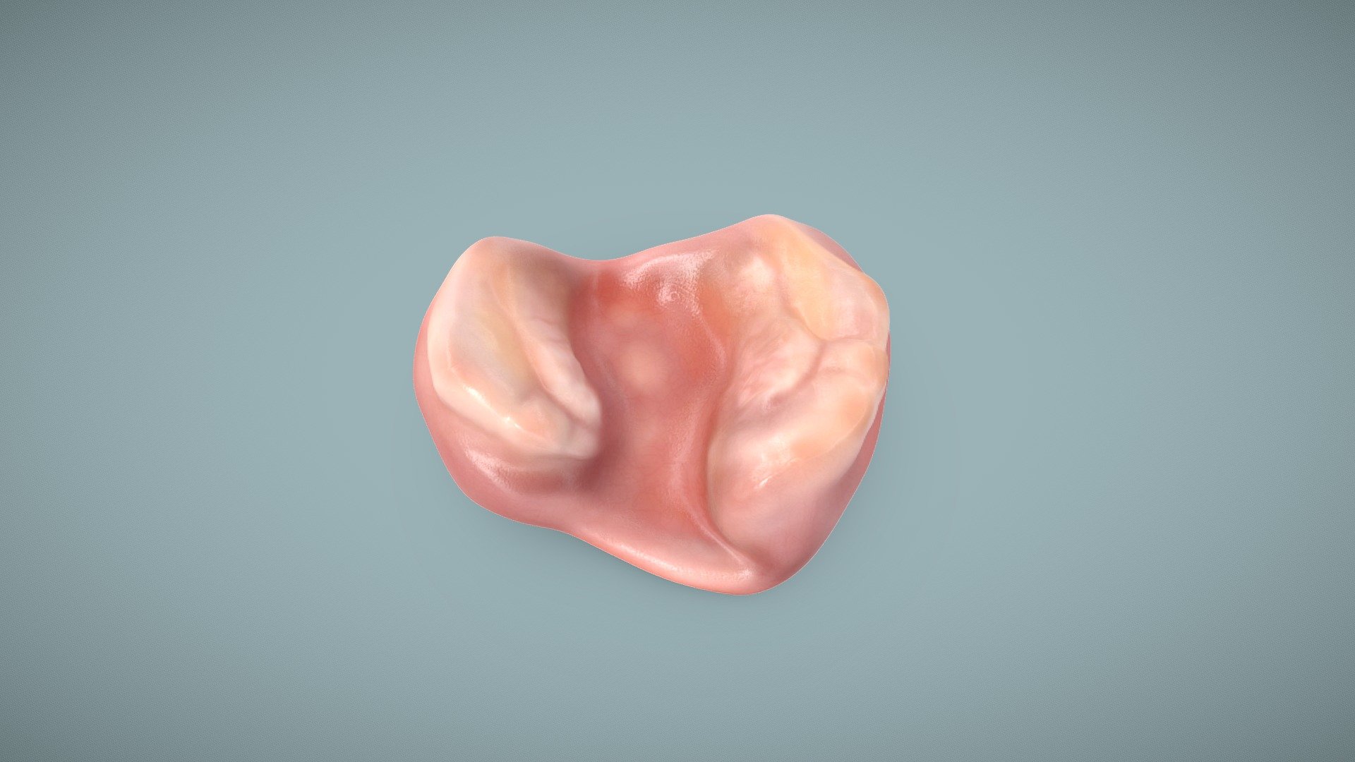 Unilateral Cleft Palate - 3D model by AUmedart [5d3373f] - Sketchfab