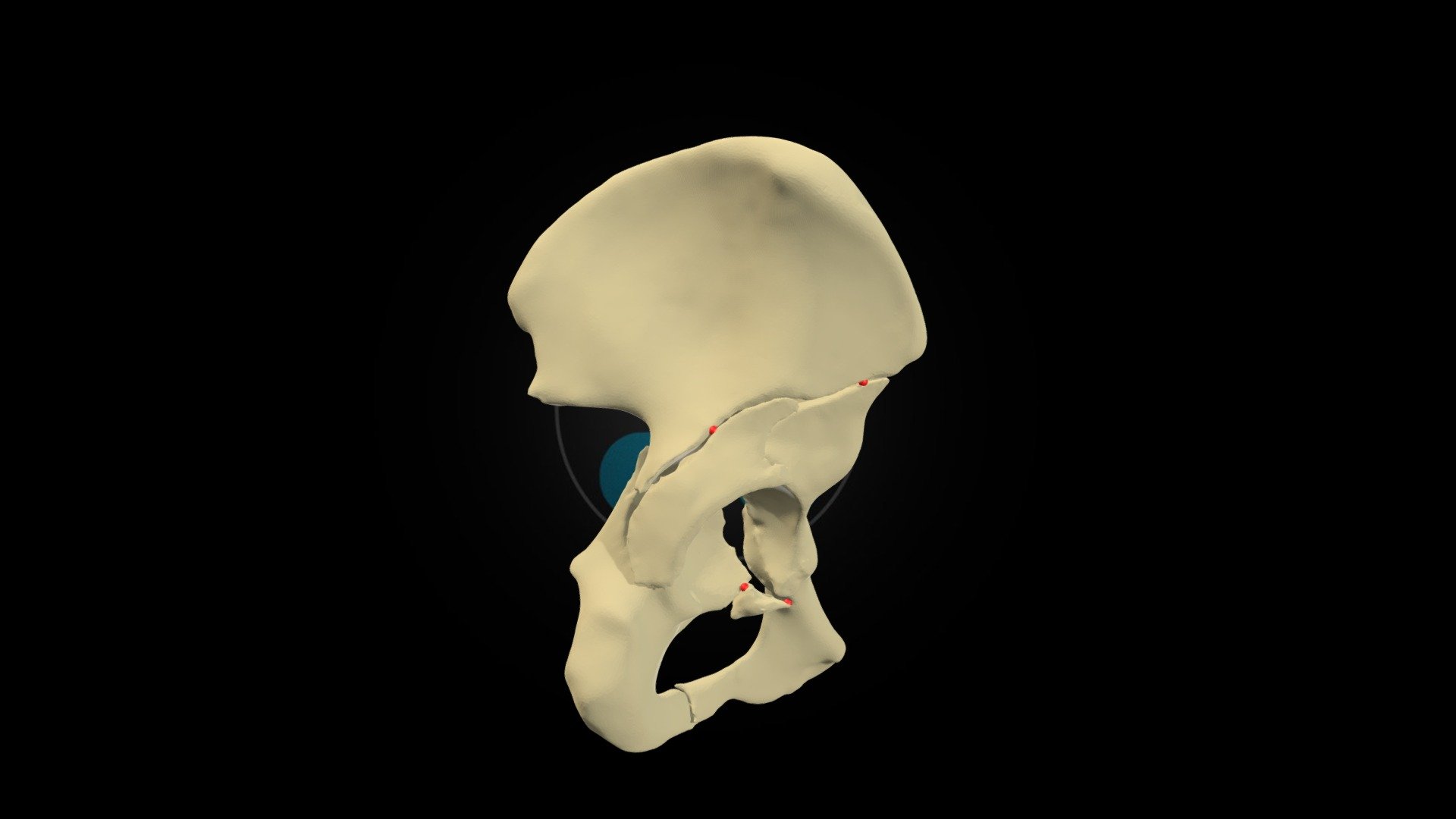 HumanX Acetabulum Fracture (m) right - 3D model by HumanX Medical ...