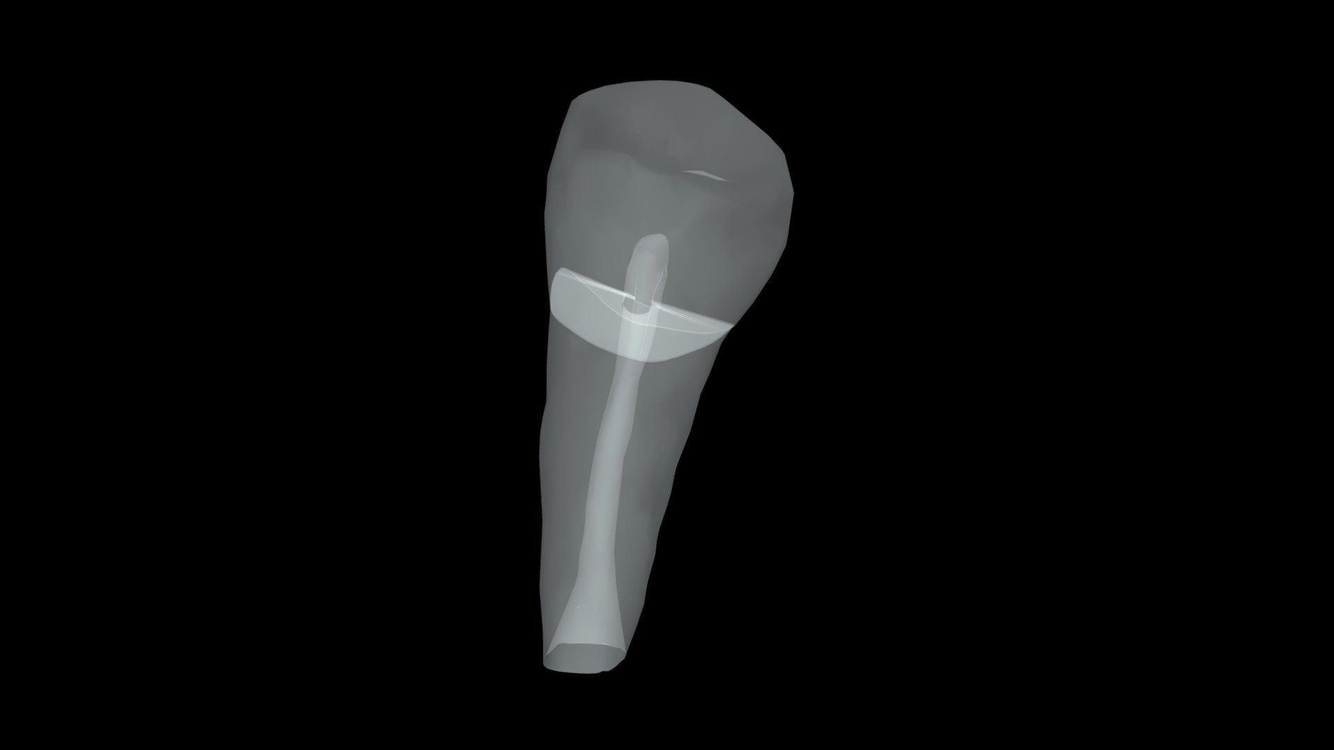 Tooth #20 with Open Apex Mandibular Pre-Molar - 3D model by biomed3d ...