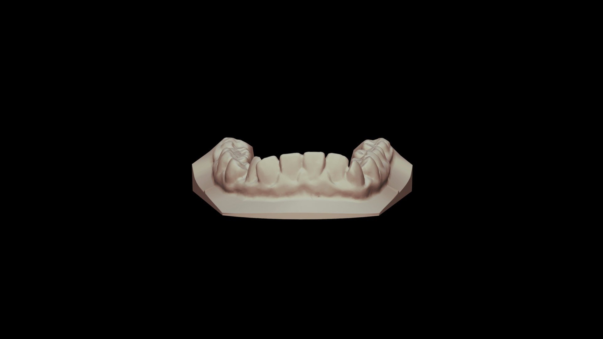 Patient 5: Mandibular Cast - 3D model by bchui [5e0778b] - Sketchfab