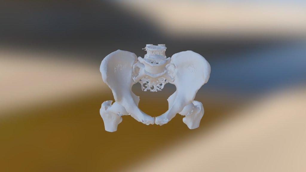 Acetabular Fracture - sku 241 - 3D model by orto3d [5e3745f] - Sketchfab