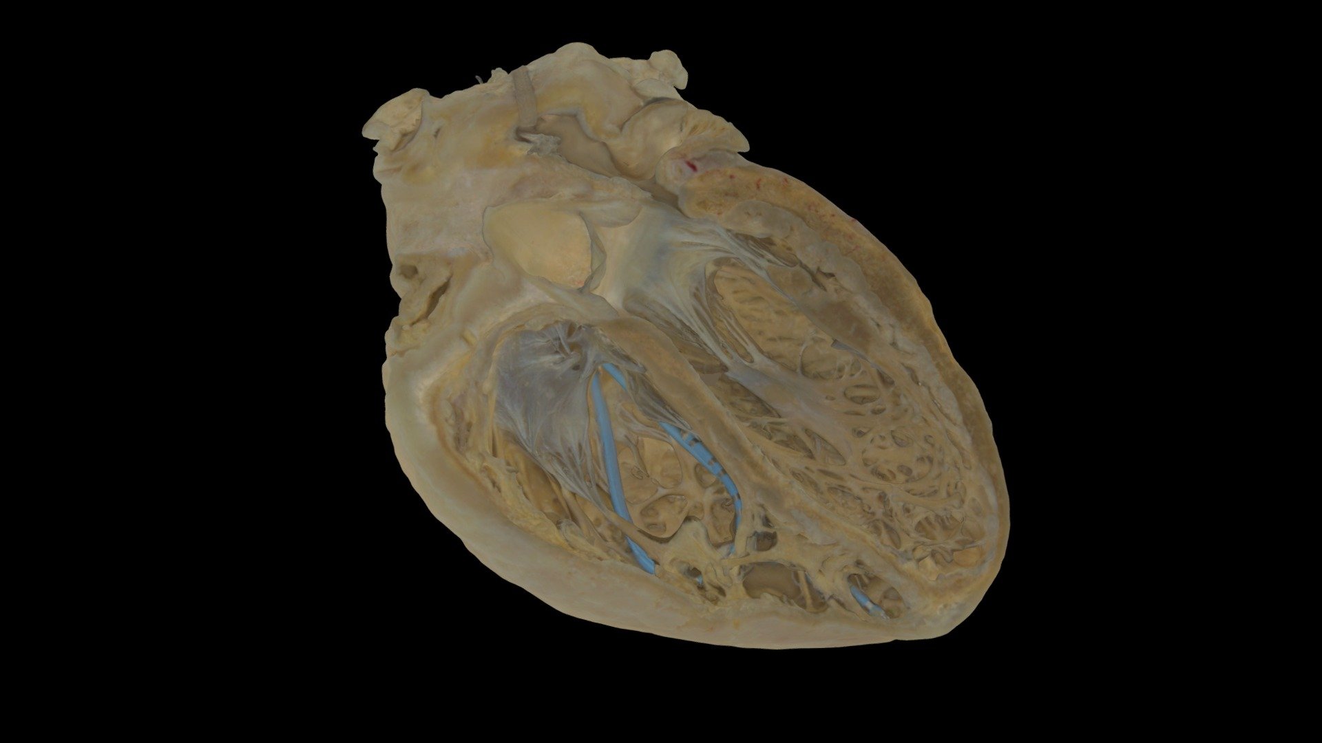 Human Right Ventricle with Mapping Catheters - 3D model by ...