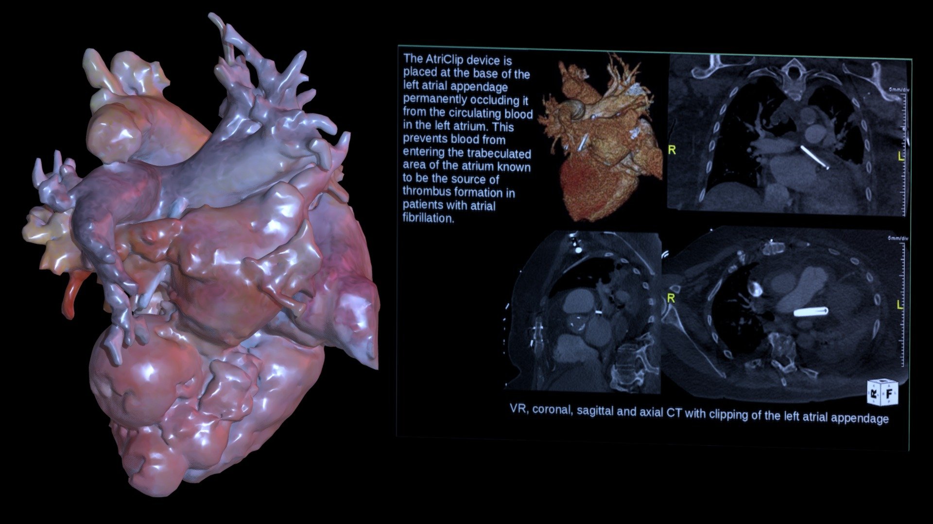 Left Atrial Occlusion Clip - Download Free 3D model by tl0615 [5e77ed1 ...