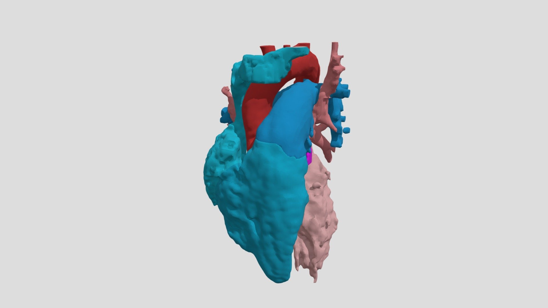 Left Ventricle Aneurysm (S0281) - 3D model by NCHS Cardiac Advanced ...