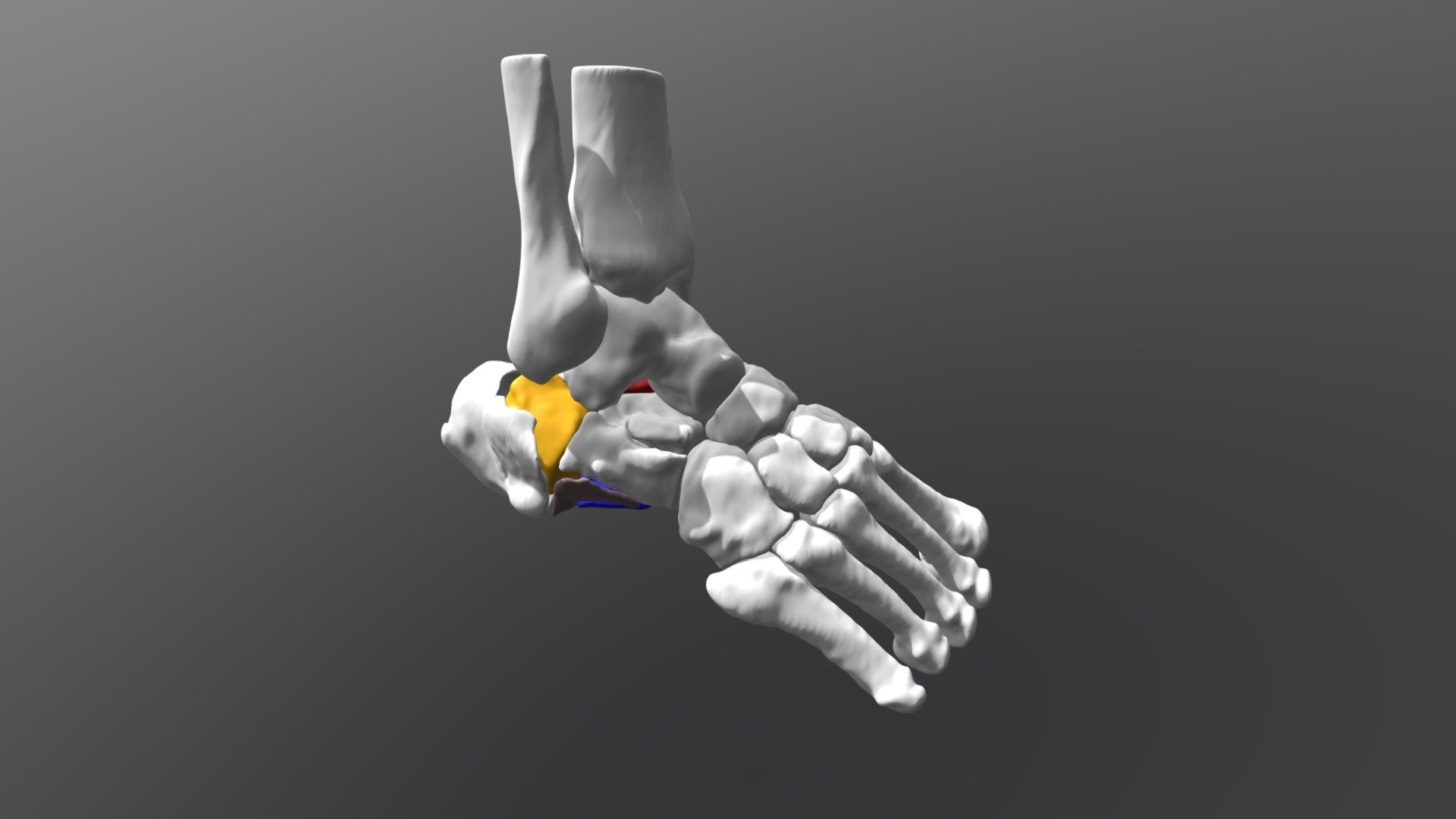 Compression fracture of the Calcaneus 3091 - 3D model by valchanov ...