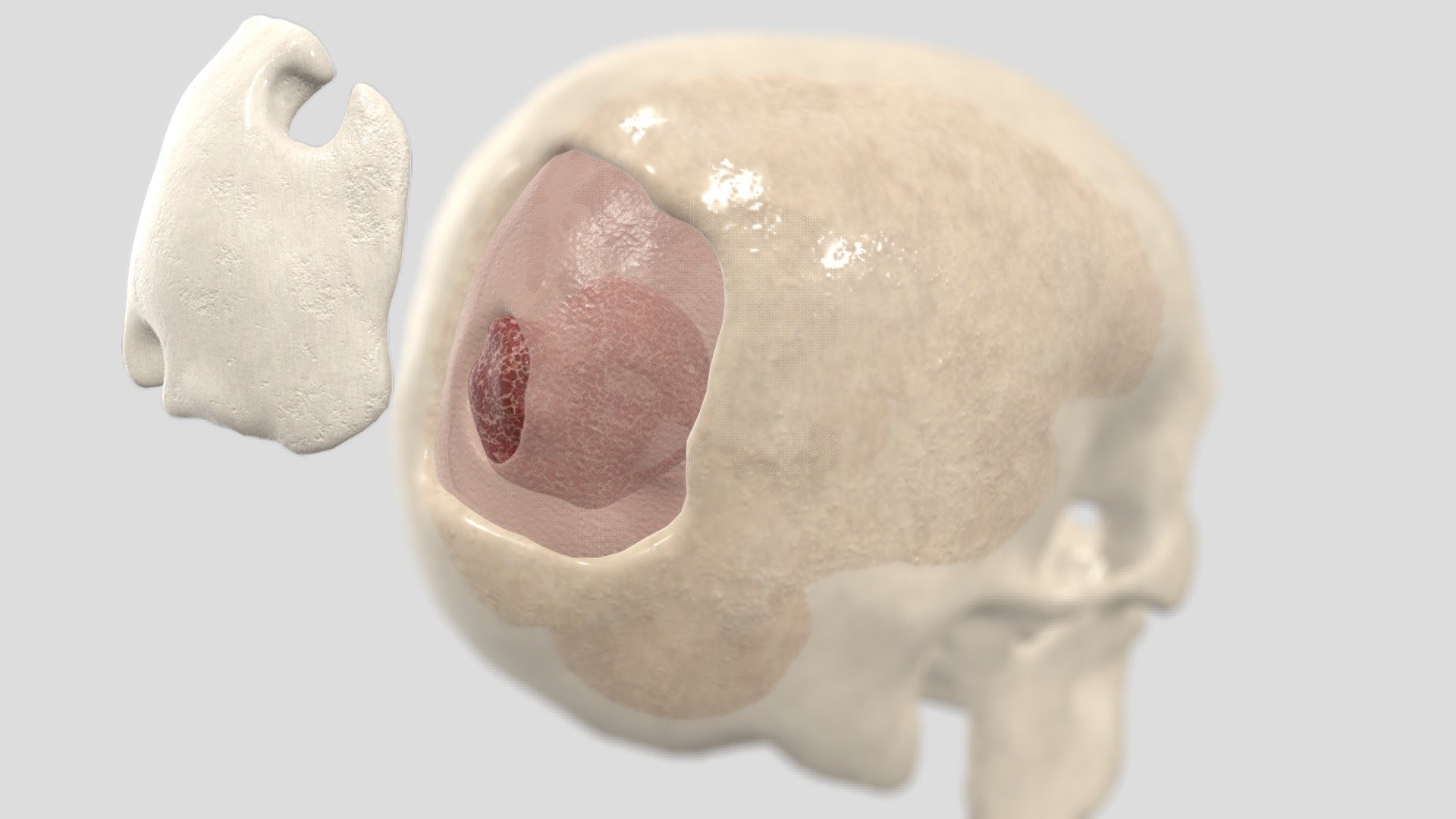 Brain Tumor - 3D model by XRTRANSFER [5f2a0d5] - Sketchfab