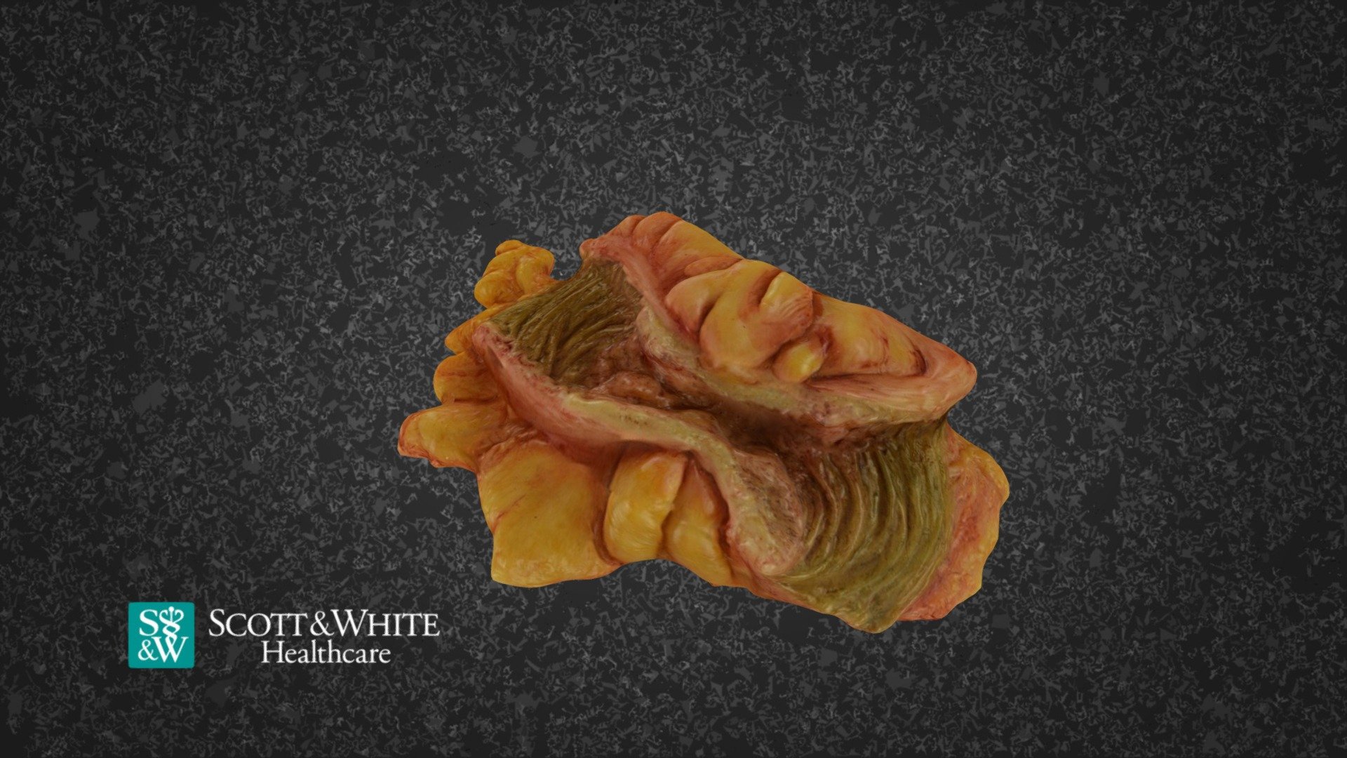 Sigmoid Cancer 141536 - 3D model by Scott & White Moulage Project ...