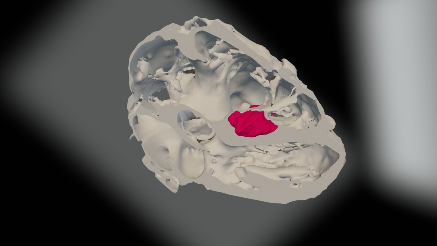 septaltumor - 3D model by philill [6163a80] - Sketchfab