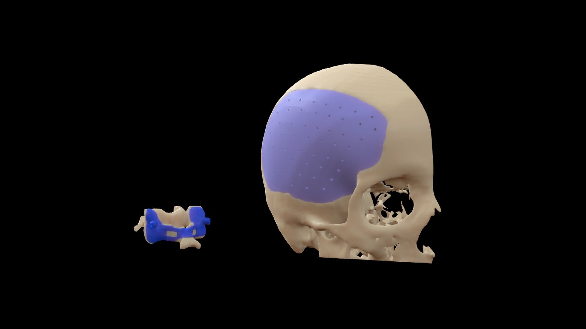 Mimics 3-matic CT Models - 3D model by Terrie Simmons-Ehrhardt ...