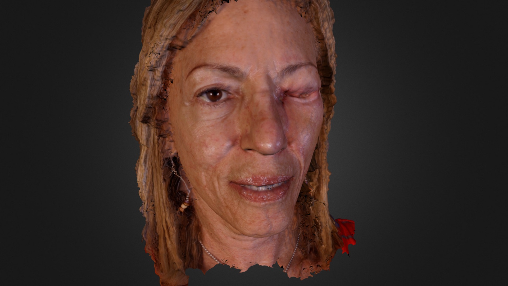 EYELID RECONSTRUCTION - 3D model by orenteppermd [627060b] - Sketchfab