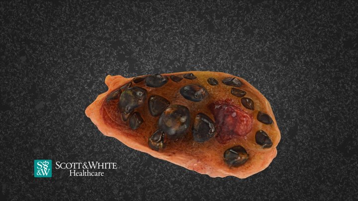 Gallstones 3D models - Sketchfab